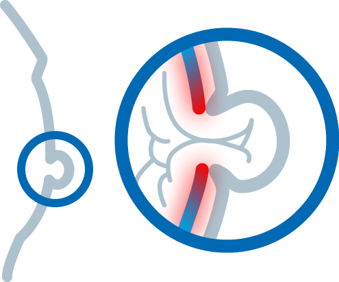 Nabelbruch (Nabelhernie) » Ursachen, Symptome & Behandlung